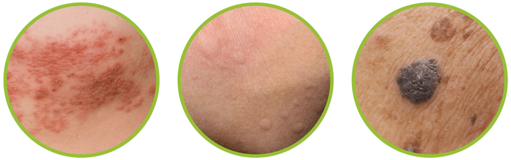skin-condition-circles | DirectDerm