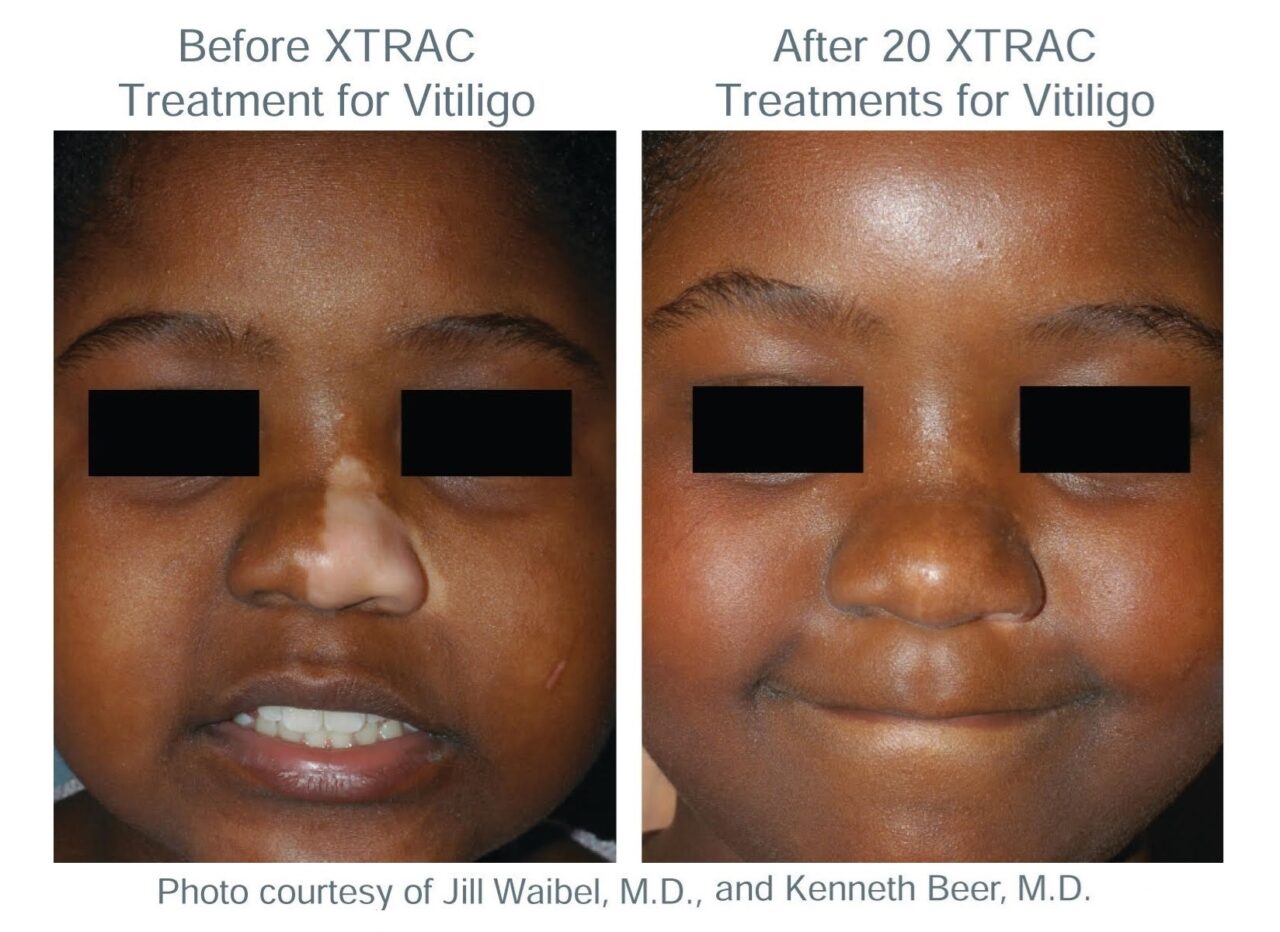 Xtrac | DirectDerm